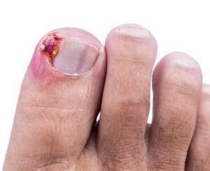 Infected Toe (A Guide To Your Dealing With Your Toe Pain)