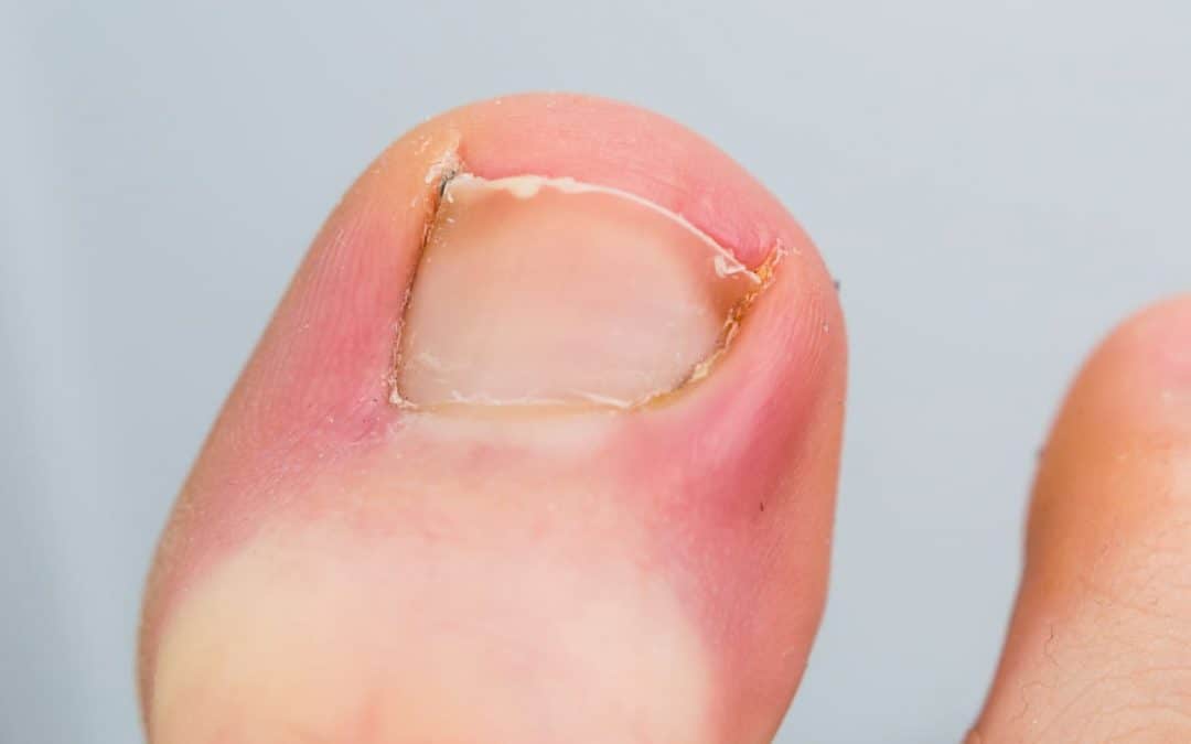Infected Toe (A Guide To Your Dealing With Your Toe Pain)