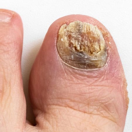 The Ultimate Guide To Fungal Nail Infections