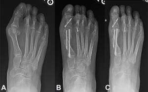 Different Types of Bunion Surgery: A Comprehensive Guide