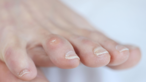 Understanding Corn on Foot: Causes and Treatment