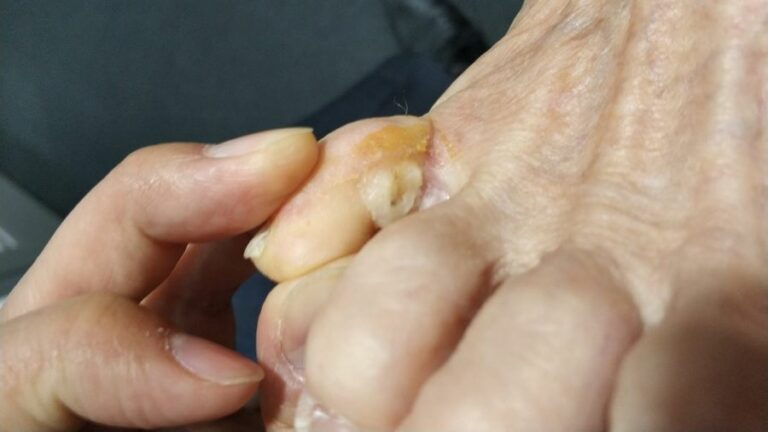 Understanding Corn on Foot: Causes and Treatment