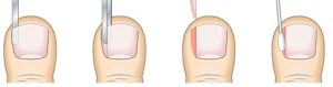 Nail Surgery (Partial Nail Avulsion - PNA) | In Room Procedure
