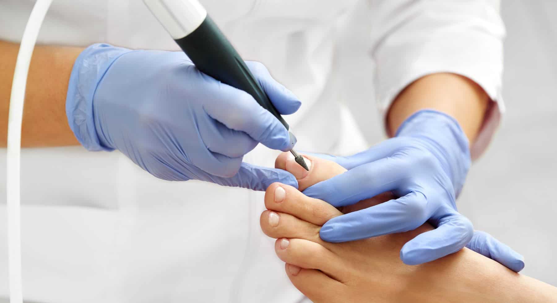 Fungal Nail Laser Treatment - Is it Worth it? - ModPod Podiatry