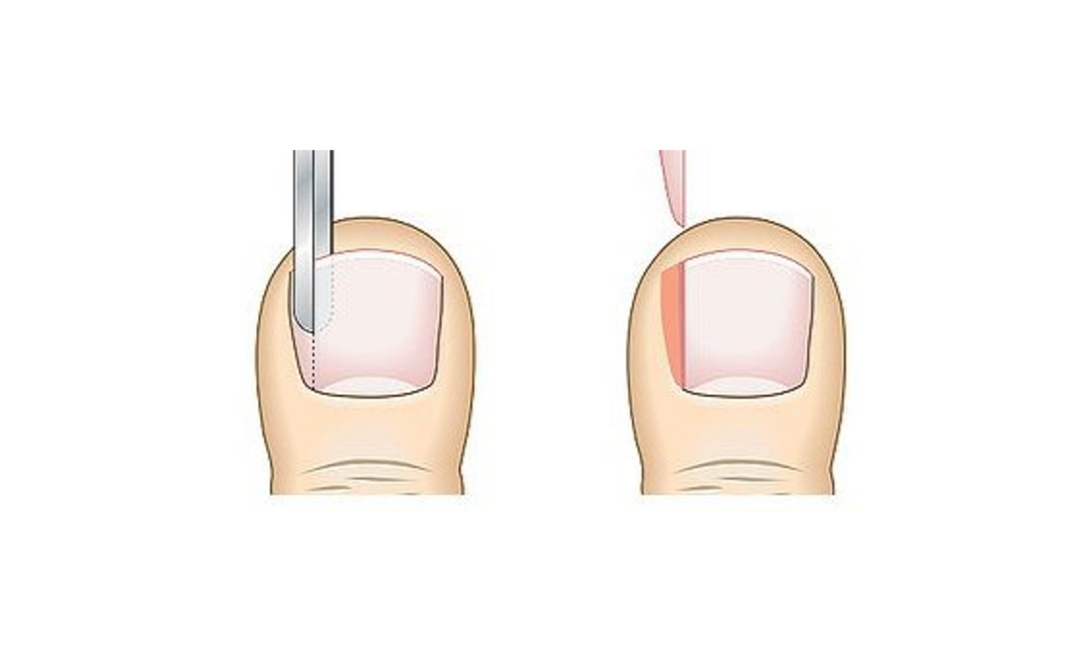 Ingrown Toenail Removal: Expert Treatment for Painful Toenails